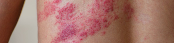 Symptoms & Complications