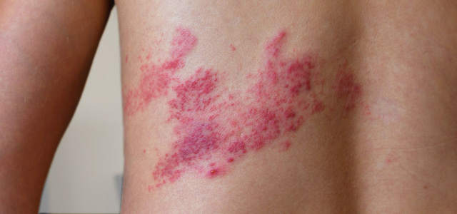 Symptoms & Complications